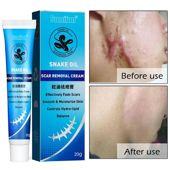 Best price for 20g Old Scars Eraser Cream Healing Remove Pregnancy ...