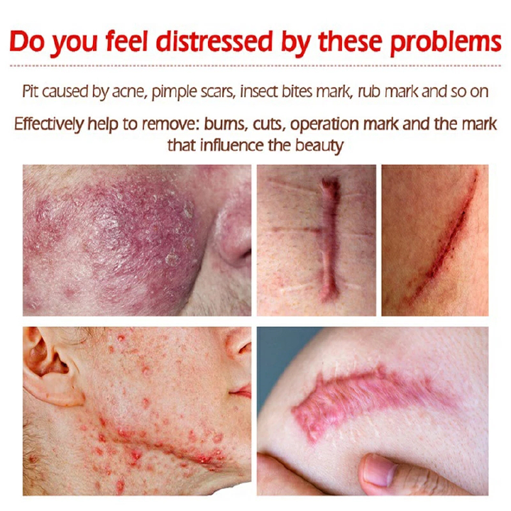 Best price for Scar Removal Cream Gel Remove Acne Spots Treatment ...