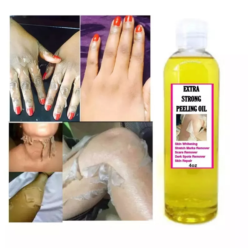 Best price for Extra Strong Yellow Peeling Oil – Scar & Stretch Mark ...