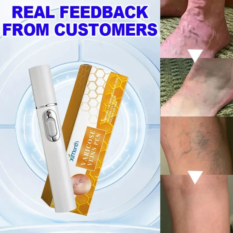 Best price for Scar LASER PEN For all kinds of scars Burn Surgical scar ...