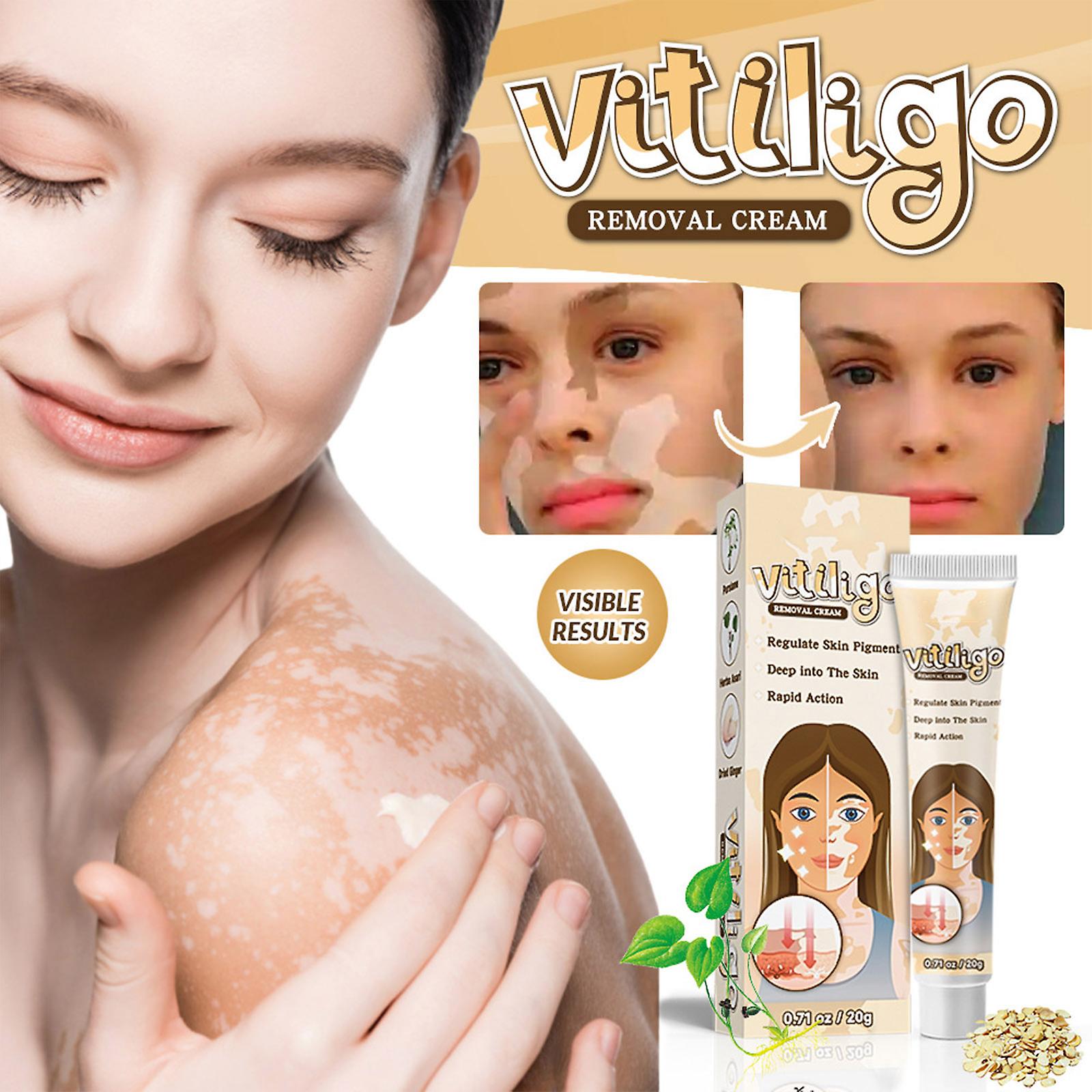 Best price for Sumifun Vitiligo Removal Cream Vitiligo Cleansing Cream ...
