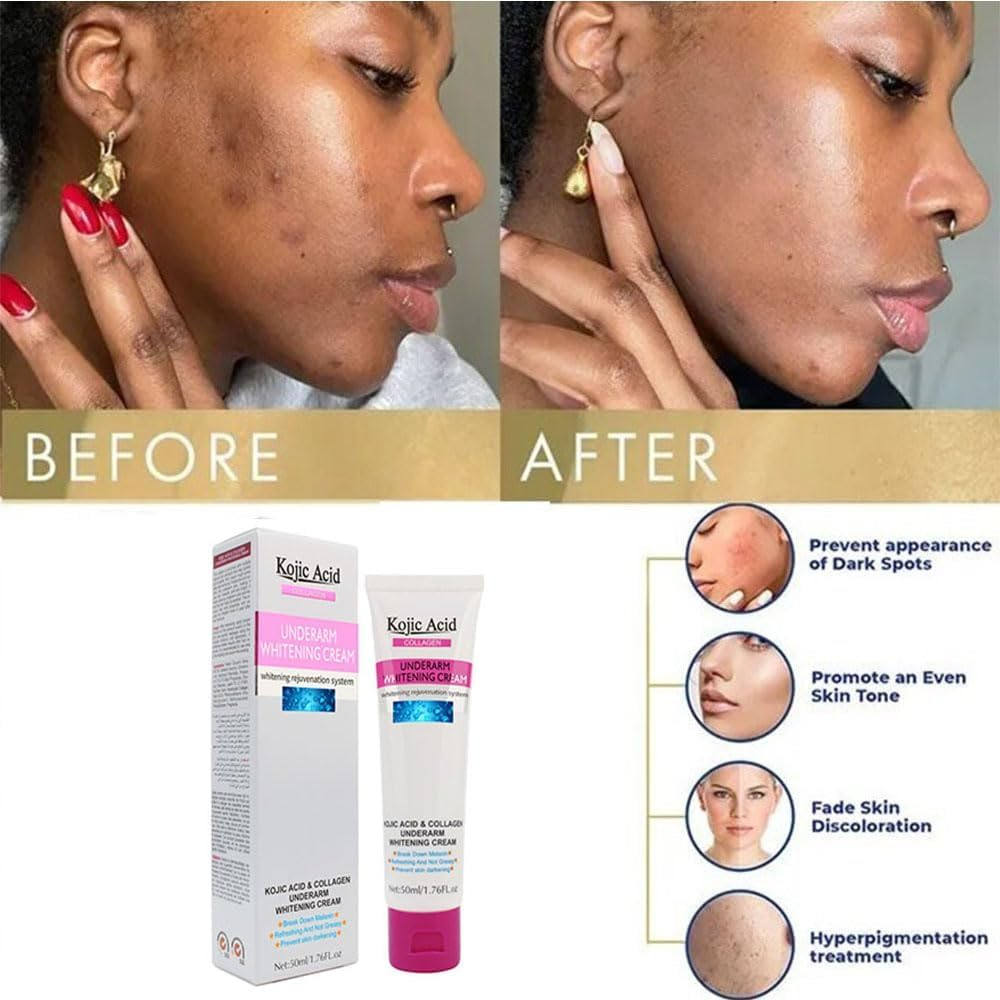 Best price for Kojic Acid Skin Lightening Cream removes dark spots and hyperpigmentation on ...